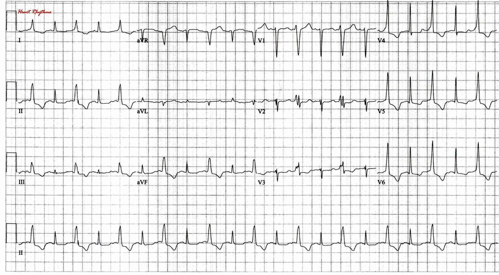 ECG Rhythms: QRST alternans
