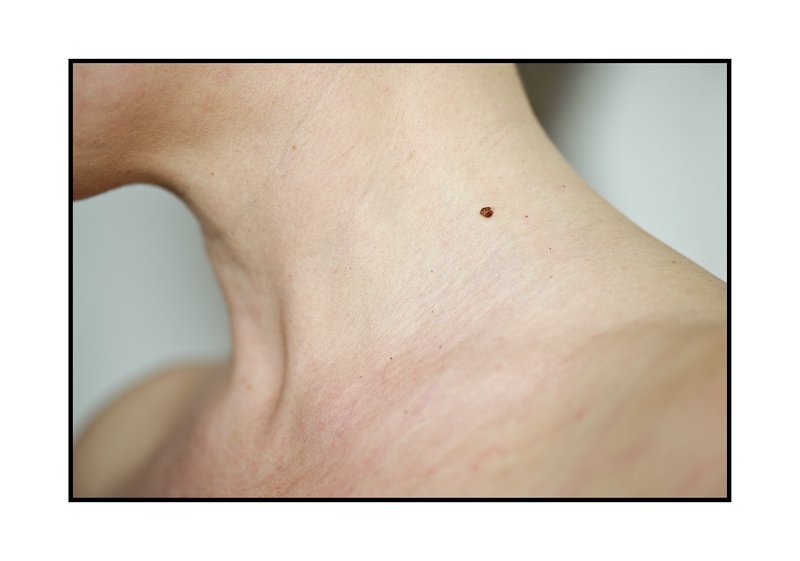 Lucky & Unlucky Moles On Female/Male Body Parts ~ INDIAN PALMISTRY ...