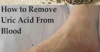 Boost Flow: How to Remove Uric Acid From Blood