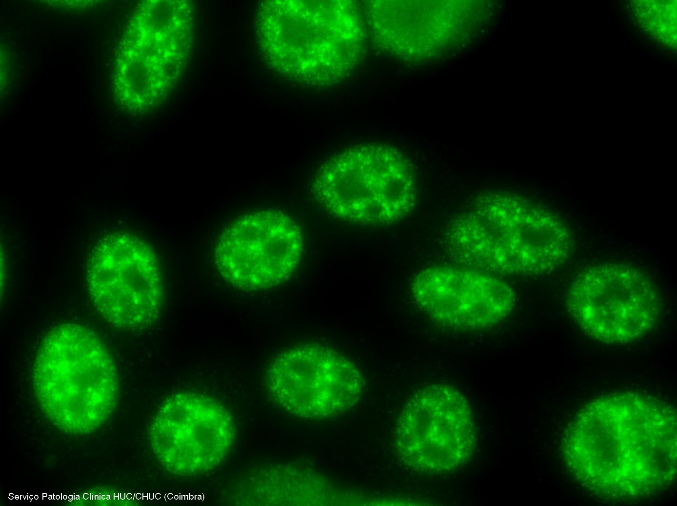 Anticorpos anti - Sm e anti - RNP