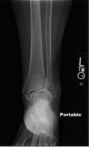 Case of the Month: Fracture cases at Harborview Medical Center ...