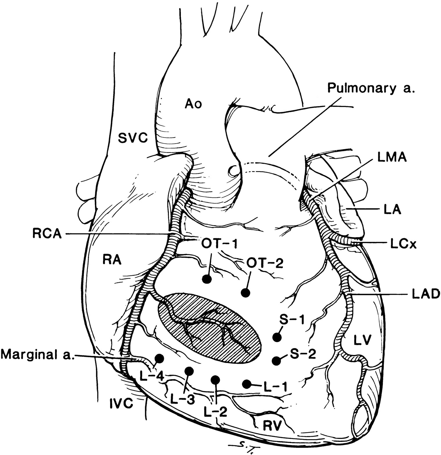 Right Ventricular ST Elevation Myocardial Infarction | INA - ECG
