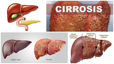 Tratamiento Natural Cirrosis - Tratamientos Naturales Yuno