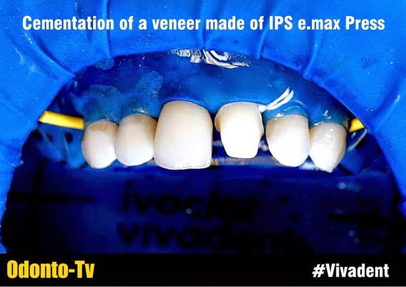 Variolink Esthetic LC: Cementation of a veneer made of IPS e.max Press ...