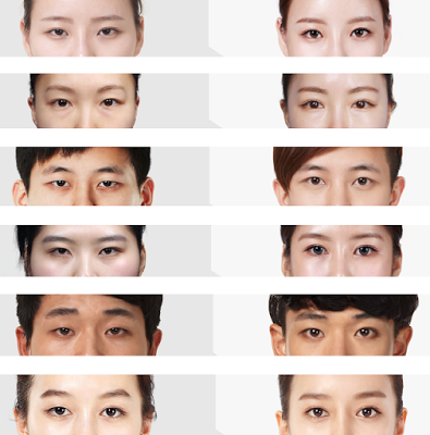 TL PLASTIC SURGERY CLINIC KOREA: Small eyes plastic surgery