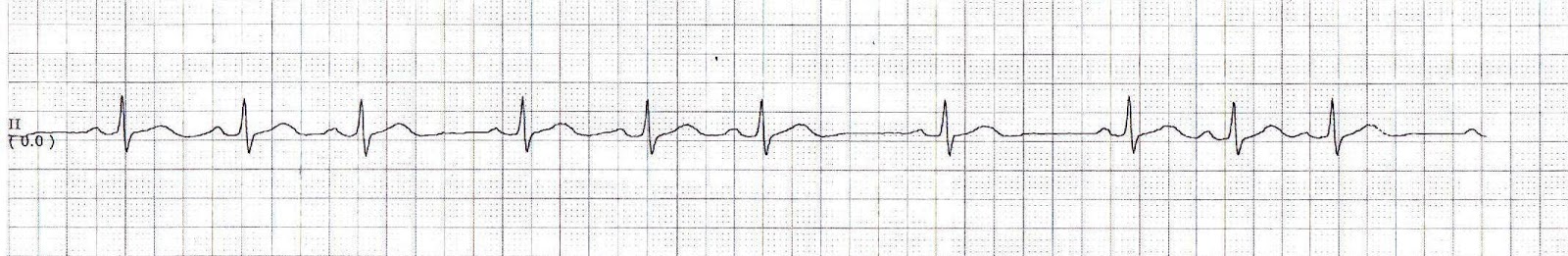 ECG Channel: Sinoatrial Block or Sinoatrial Exit Block