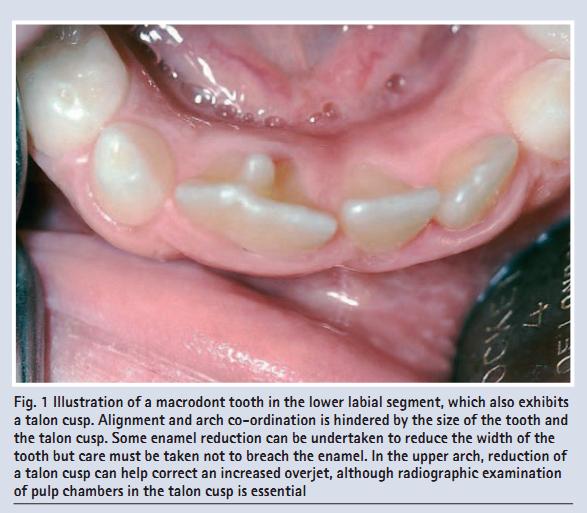 Dentistry lectures for MFDS/MJDF/NBDE/ORE: A NOTE ON- Extractions In ...