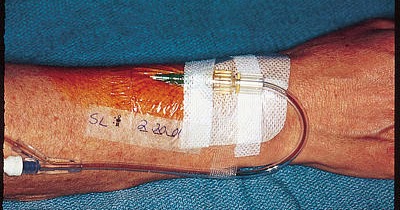 ¡Qué inflamado está esto!: Flebitis