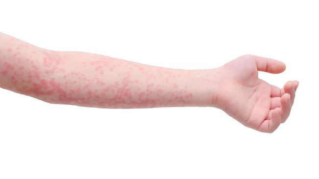 Demam Scarlet Di Kalangan Kanak-Kanak, Cara Cepat Sembuh - Story of ...