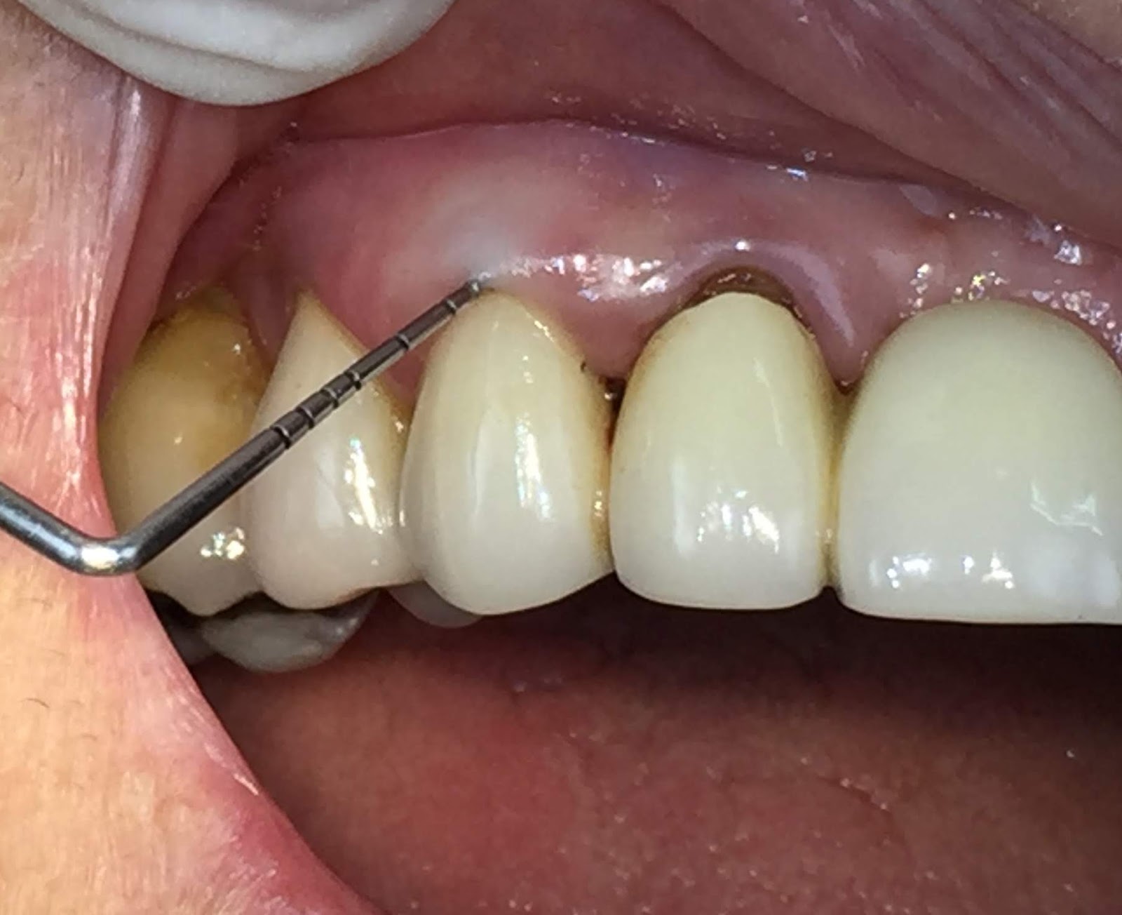 Odontologia - TM: Exame Periodontal - Periograma