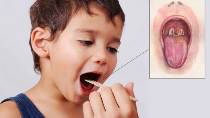 Kenali Lebih Dini Penyakit Difteri - RASAKAN