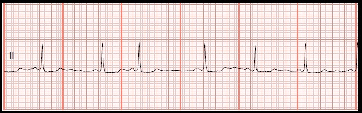 EKG Rhythm Strip Quiz 139
