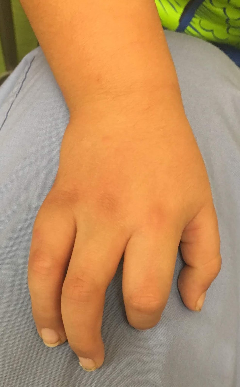 Unusual "Extra" Finger | Congenital Hand and Arm Differences ...