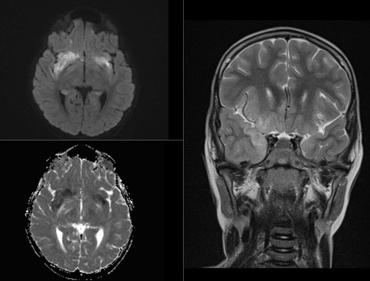 Herpes Simplex Encephalitis