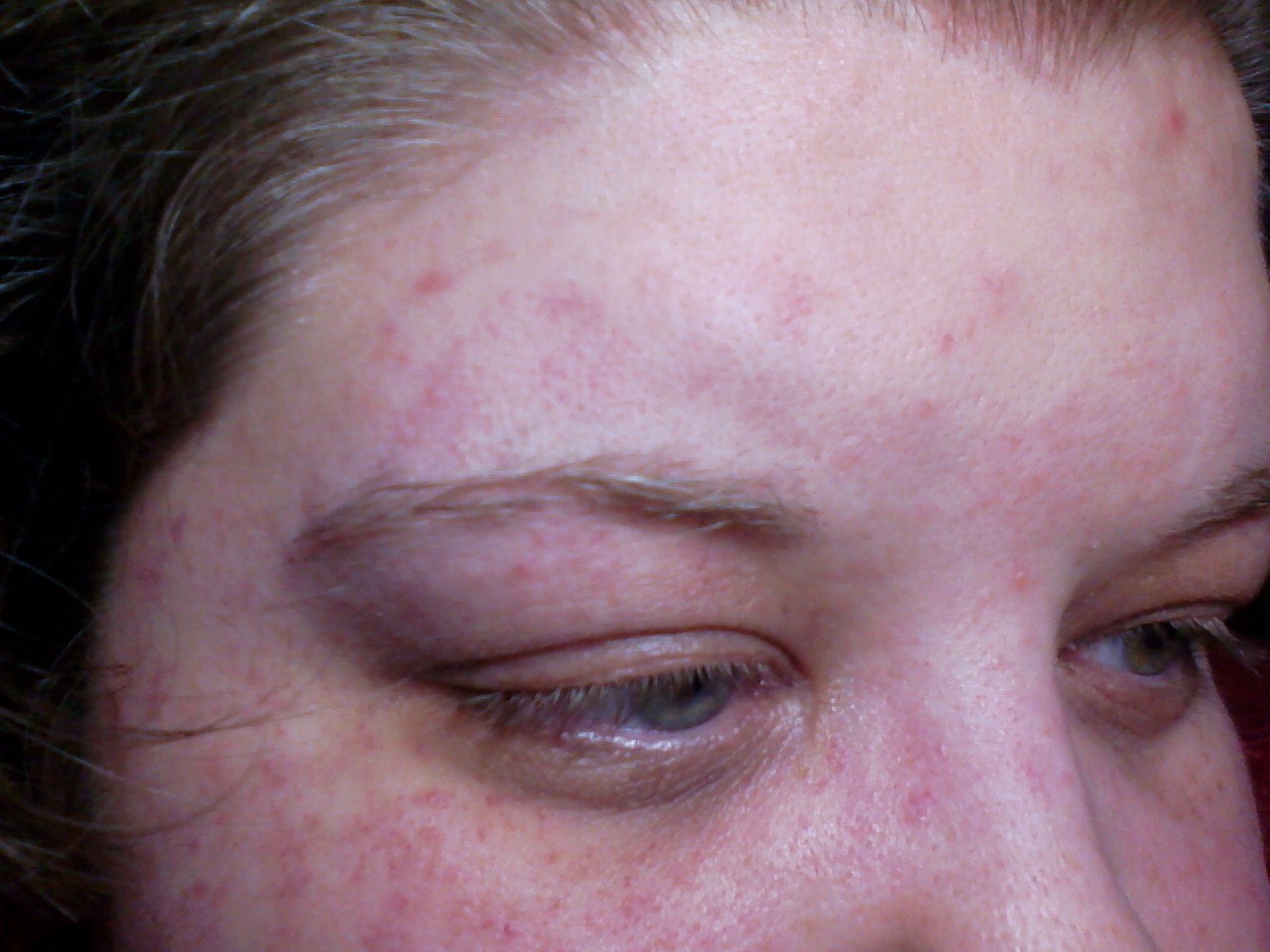 Butterfly Days A Year With Cyclic Vomiting Syndrome butterfly-days-a-year-with-cyclic-vomiting-syndrome