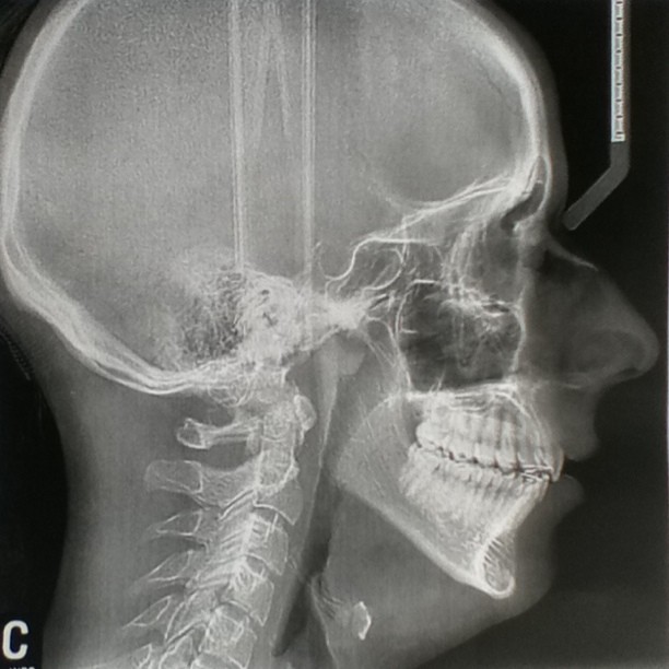 Hilary's Broken Face: Lateral Ceph X-ray with Soft Tissue