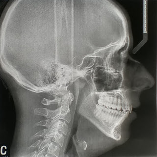 Hilary's Broken Face: Lateral Ceph X-ray with Soft Tissue