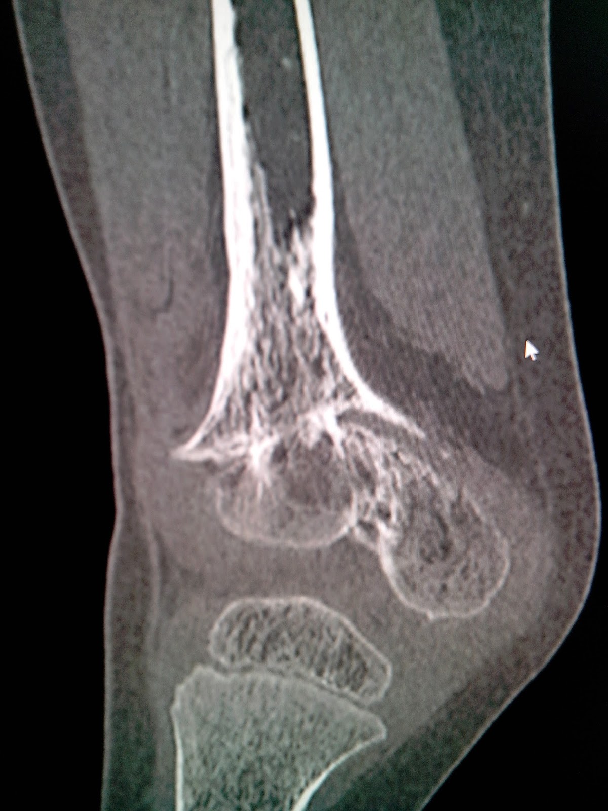 PHYSEAL BAR-CT - Radiology Imaging