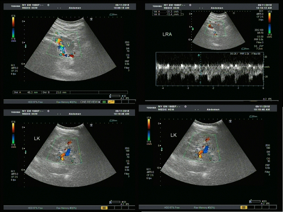 VIETNAMESE MEDIC ULTRASOUND: CASE 345: LEFT RENAL VENOUS ANEURYSM, Dr ...