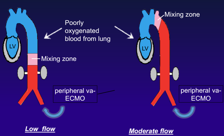 ER goldbook: ECMO (4/6): Patient related management