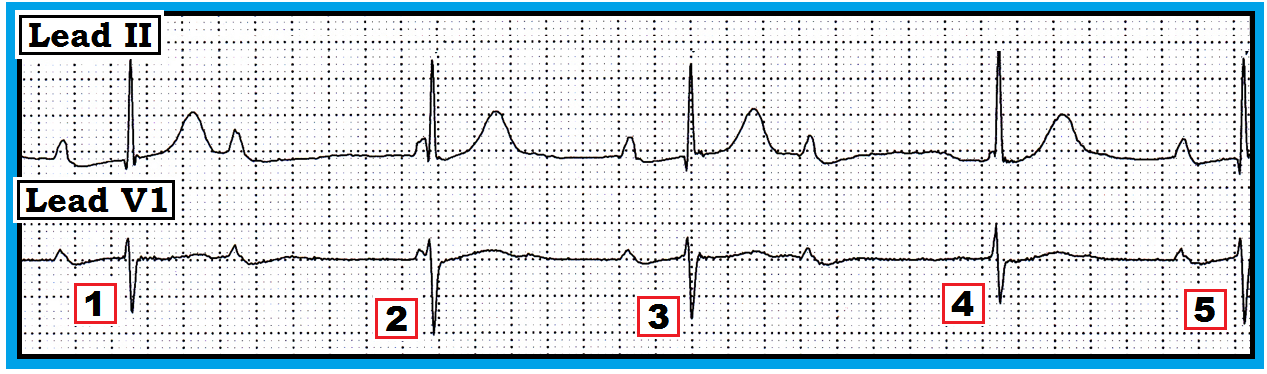 ECG Interpretation: ECG Interpretation Review #61 (AV Block – Mobitz I ...