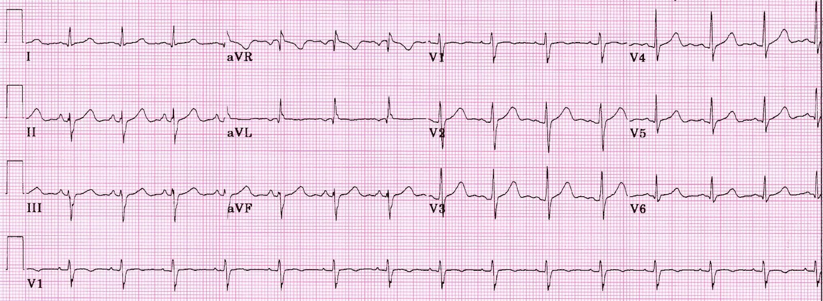 Study Medical Photos: Left Anterior Fascicular Block - ECG