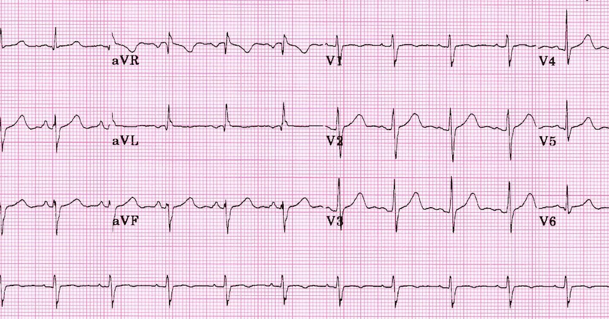 Study Medical Photos: Left Anterior Fascicular Block - ECG