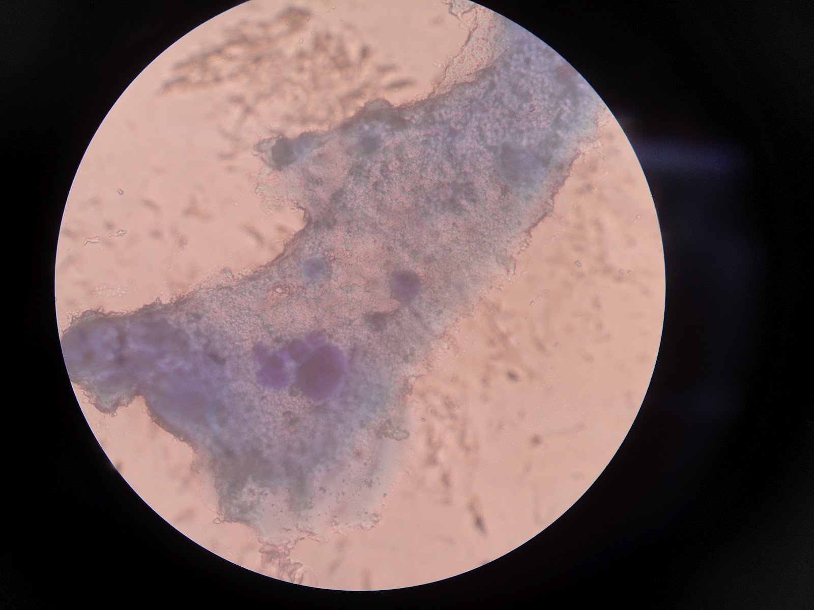 Astazia: Herpes Zoster