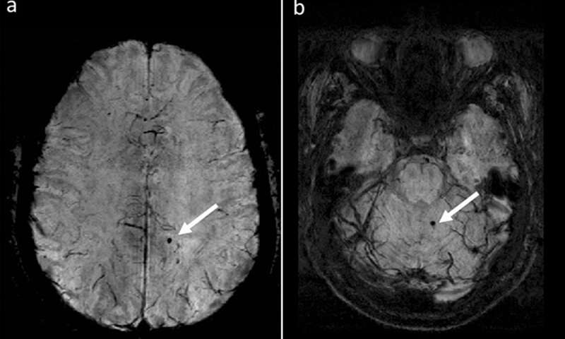 Multiple Sclerosis--the vascular connection: Cerebral Microbleeds and MS