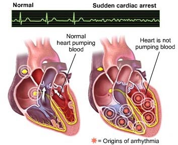 Dr Han Naung @ Henry Han : Electrophysiology and Heart Rhythm : Cardiac ...