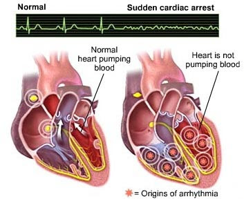 Dr Han Naung @ Henry Han : Electrophysiology and Heart Rhythm : Cardiac ...