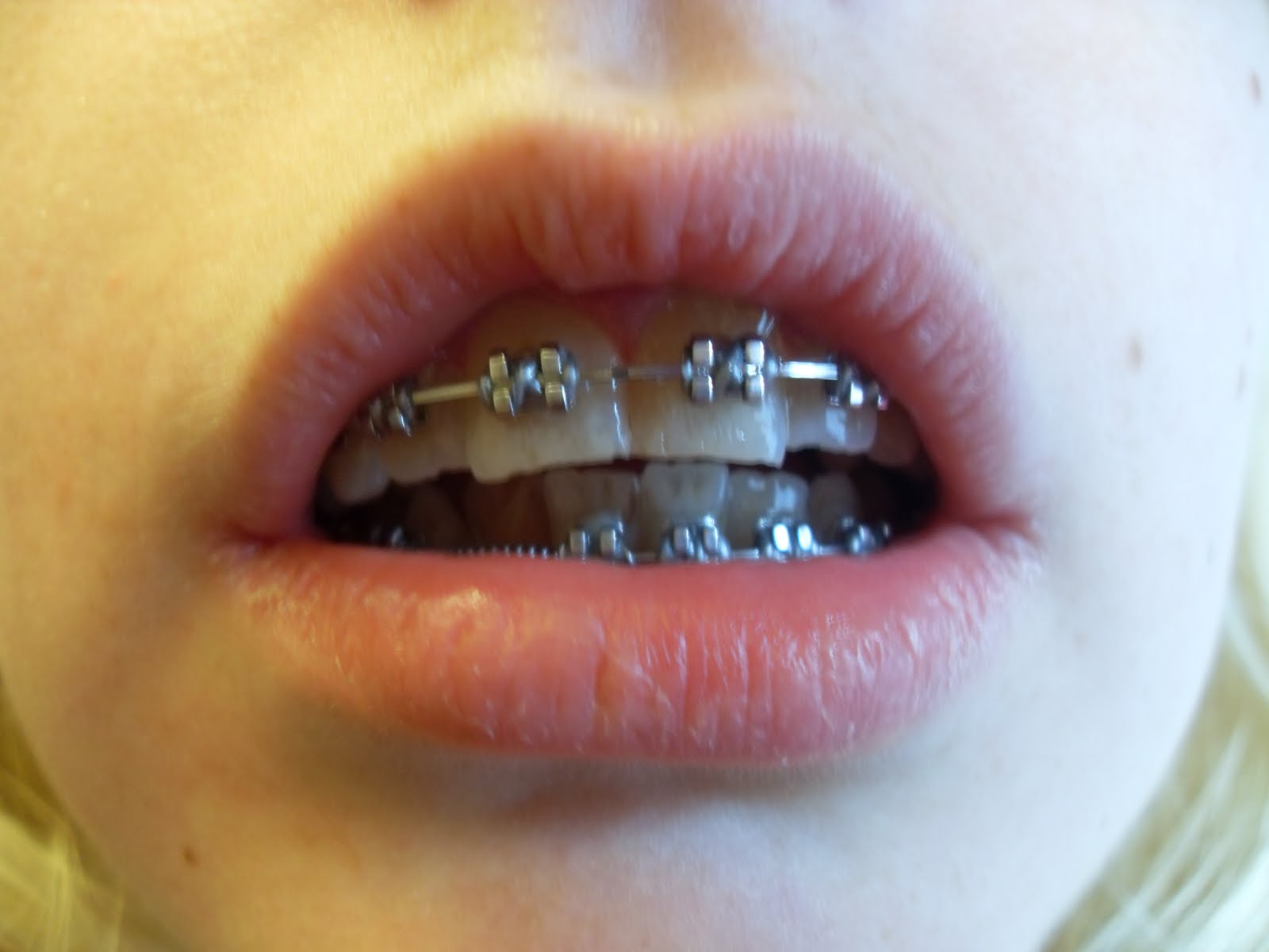 My Jaw Surgery Story: 6 months of braces and appointment update
