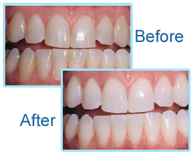 Process of Teeth Whitening - Beauty And Skin