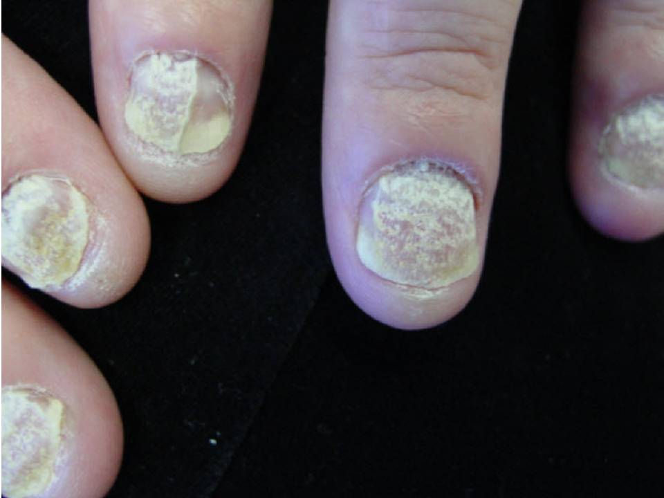 Consultations in Dermatology: The Crumbly Nail - Onychomycosis