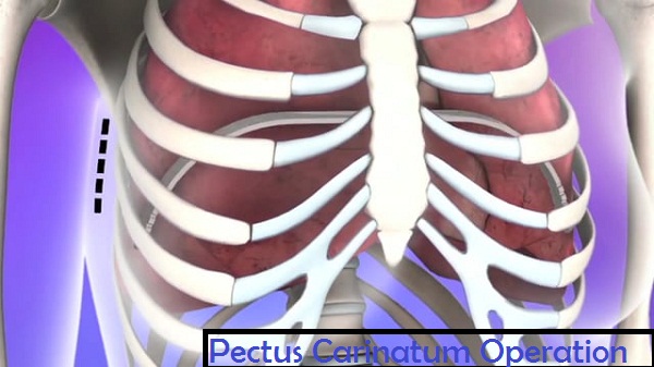 Pectus Excavatum is a Treatable Condition: Are you Suffring From Pectus ...