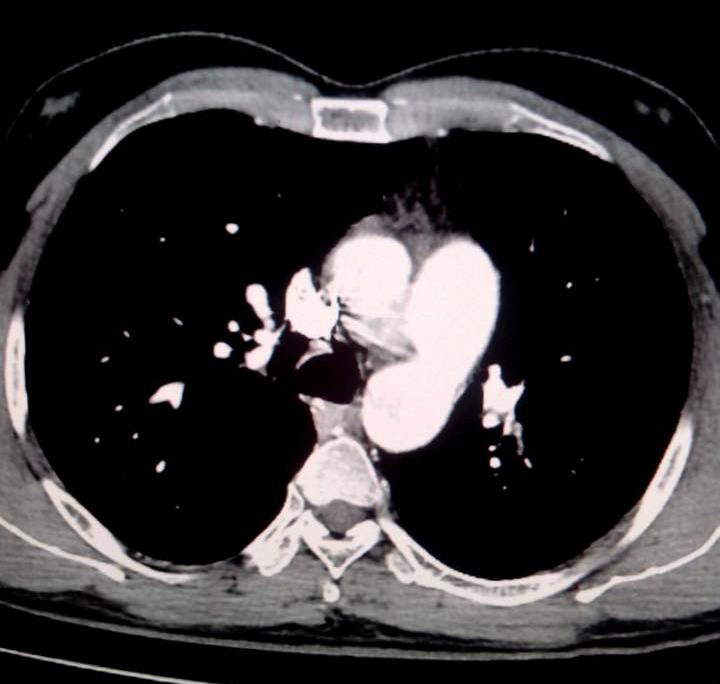 Patent ductus arteriosus-CT - Radiology Imaging