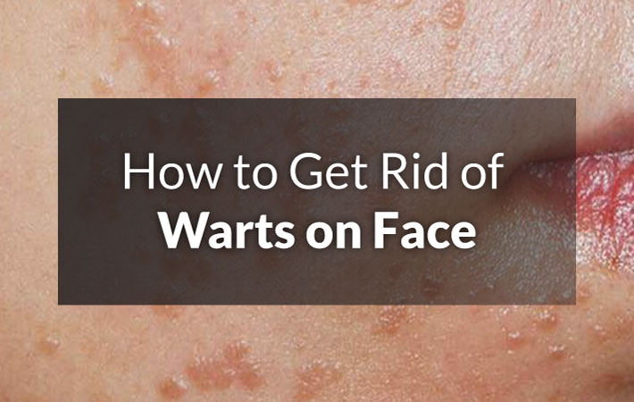 How To Remove Warts On Face - Moles, Warts & Skin Tags Removal
