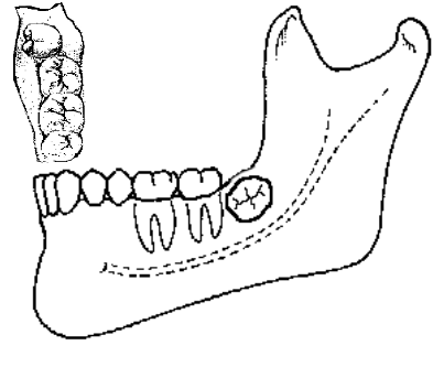 Odontologia : Dentes Inclusos: Terceiros Molares Inferiores