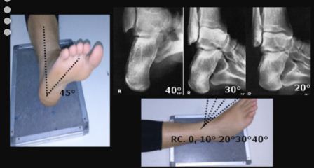 Tornozelo- Talos Obliqua Interna