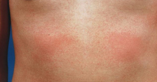 Scarlatina Rash Pictures | Medical Pictures and Images - (2023 Updated)