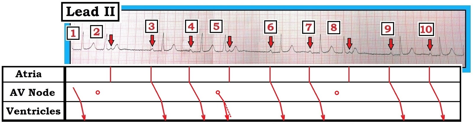 ECG Interpretation: ECG Blog #69 (Laddergrams – Group Beating)