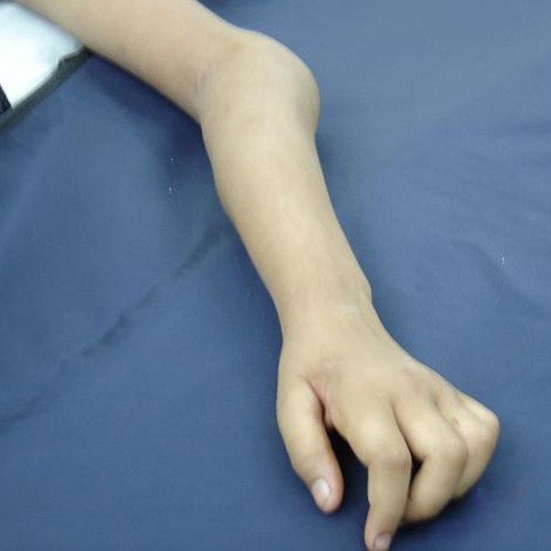 3° A Ensino Médio: Fratura Fechada