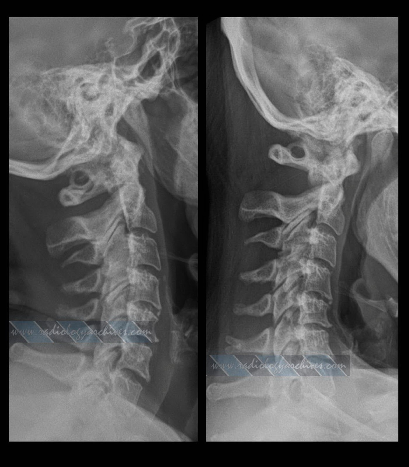 Ponticulus Posticus | Vagus nerve, X ray, Nerve