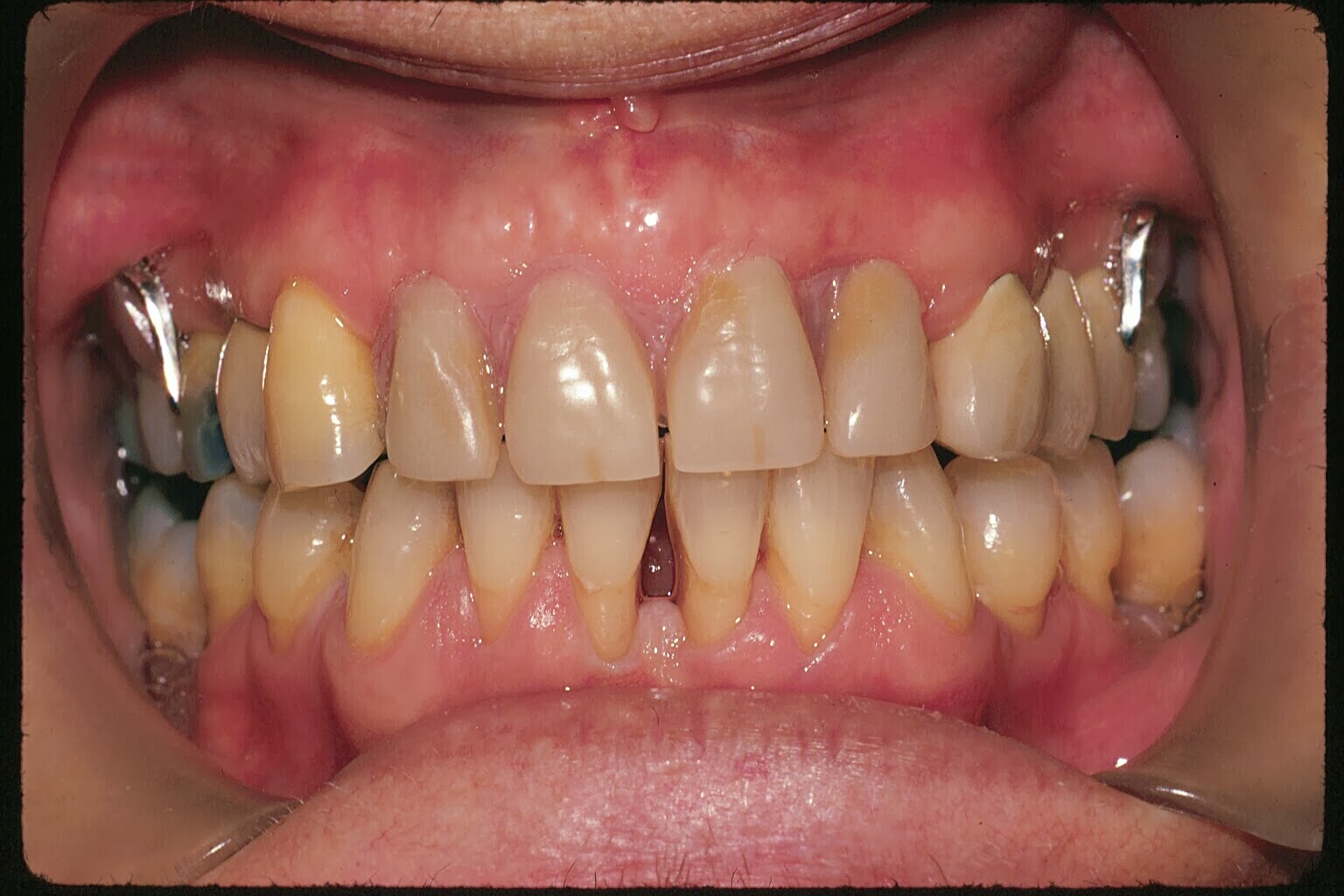 Dr. Robert G. Tupac: Prosthodontics: When A Partial Is The Right Thing ...