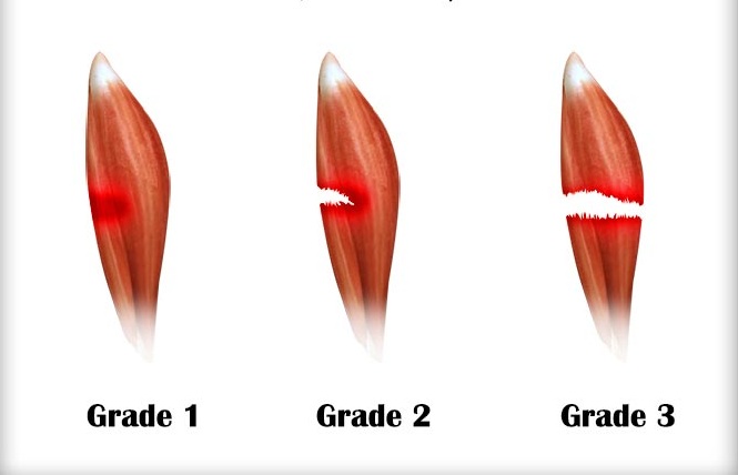 Kecederaan Hamstring Punca Sakit Bila Berjalan