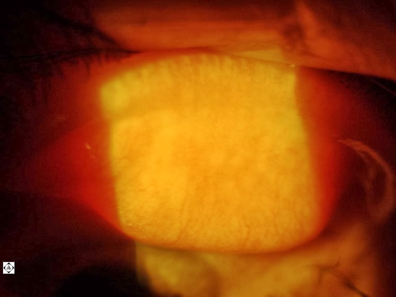 Sonoran Desert Eye Center: GIANT PAPILLARY CONJUNCTIVITIS (GPC)