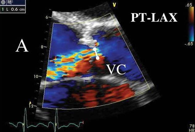 EAE Guidelines for the Diagnosis of Aortic Regurgitation