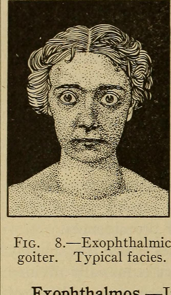 You Can Easily Find Health Tips Here: Goiter: Symptoms, causes and ...