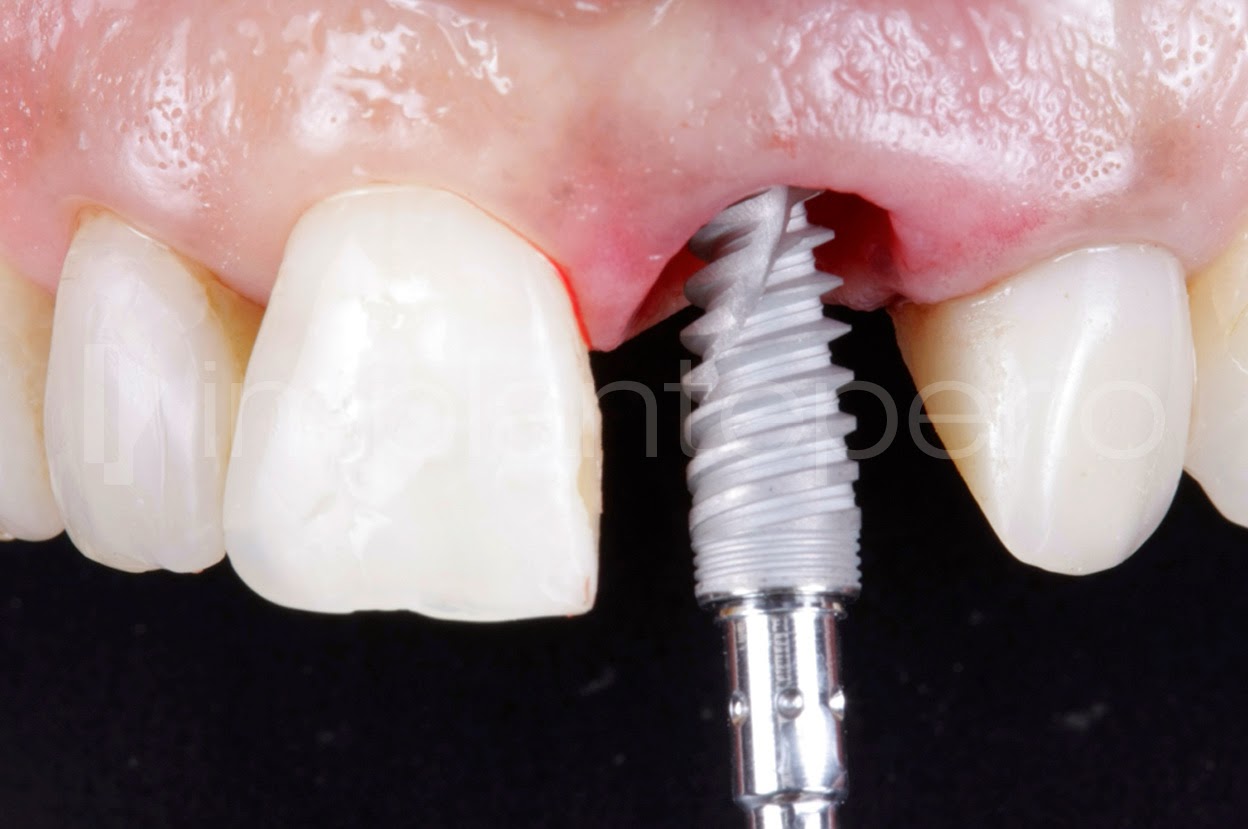 Periodontia e Implantodontia Contemporânea: outubro 2014