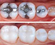 Dargan and Miller, DDS: Decision Time: Amalgam or Composite?